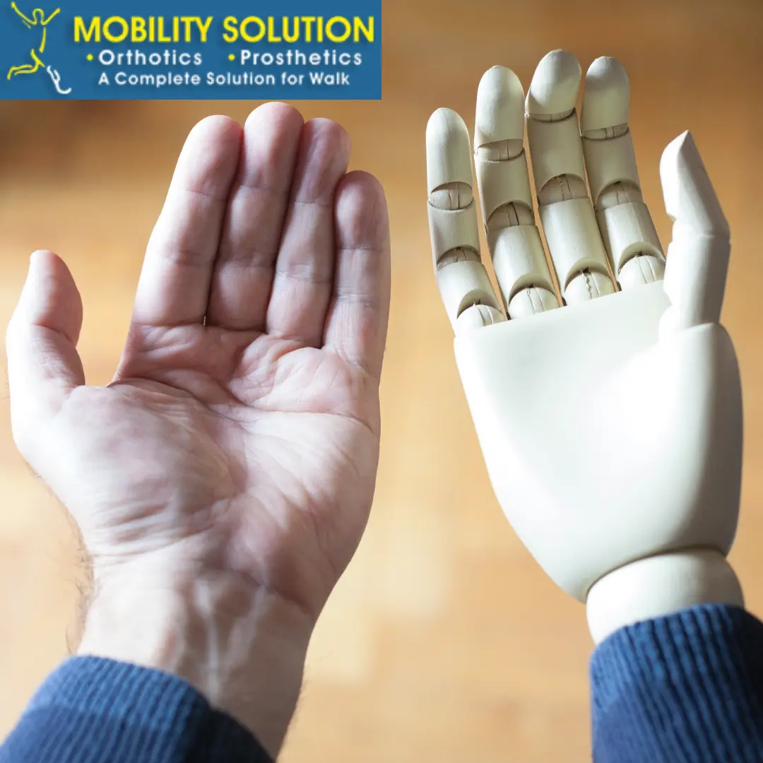 Prosthetic Hands: Cost In India, Types, And How They Work (2025 Guide)